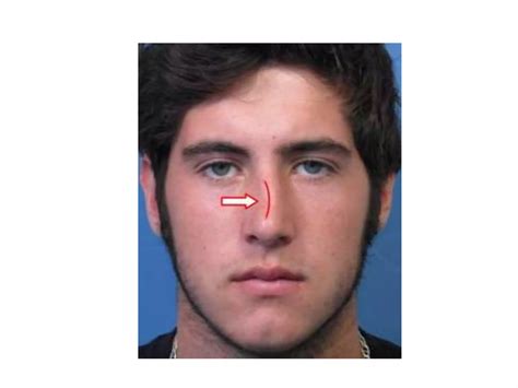 Nasal Bone Fracture Pptx