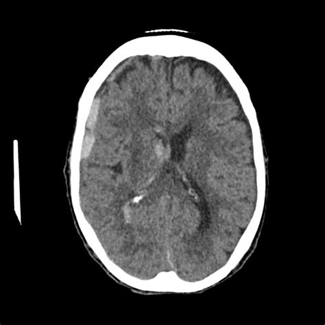 Traumatic Intracranial Hemorrhage Intracranial Hemorrhage Main