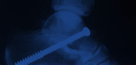 Subtalar Joint Fusion Recovery Time And Procedure Footankleaz