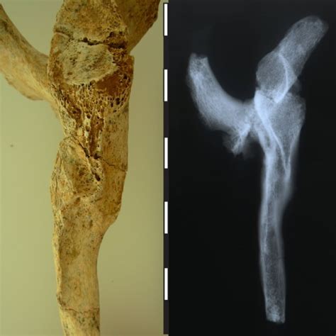 Cloaca On The Right Tibia Showing Infection Left Pus Drainage Canal