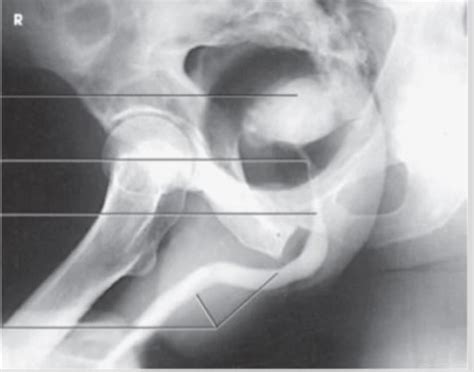 Voiding Cystourethrography Quiz