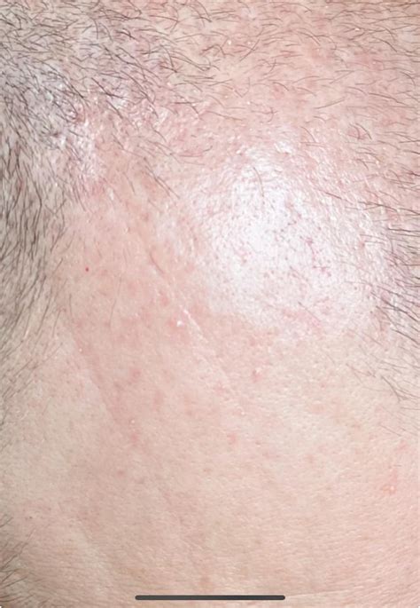 Post Accutane Tiny White Pustules And Red Spots On Forehead What Is