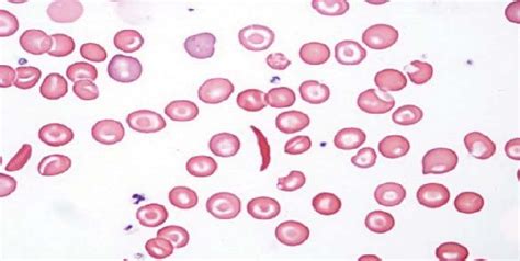 Figure 1 From Paediatric Sickle Cell Detection Using Deep Learning A