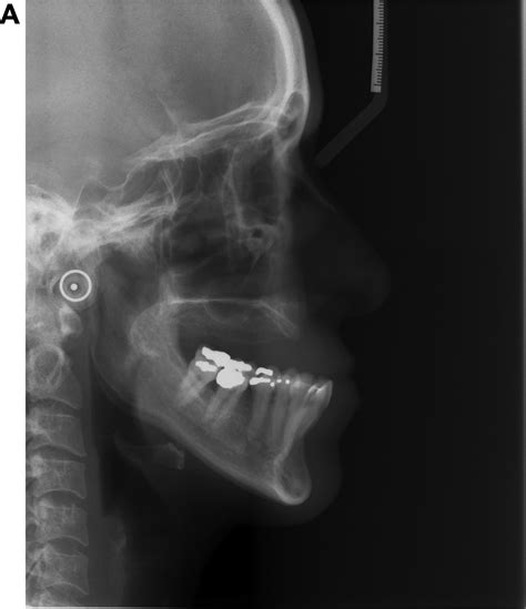 Dental Implants Can Facilitate Orthognathic Surgery In A Patient With