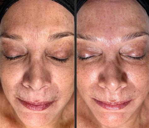 Hydrafacial Nyc Results Costs And Benefits