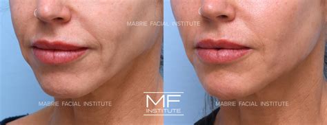 Marionette Lines And Jowling Before And After Pictures Case 998 San