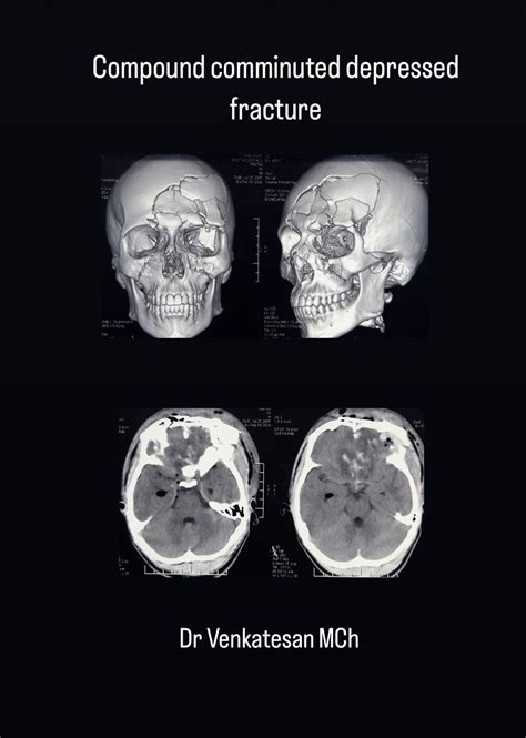 Compound Comminuted Depressed Fracture With Underlying Dural Tear And… Dr Venkatesan Sanjeevi