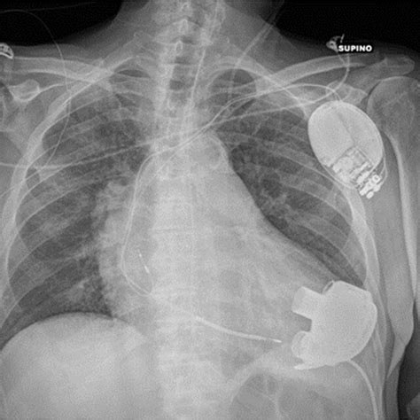 A Swan Ganz Catheter With The Tip Inside A Right Lower Lobe Pulmonary Download Scientific