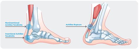 Achilles Tendon Injuries Campbell Clinic