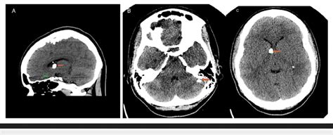 A Ct Sagittal View Showed Calcification In The Temporal Lobe Under Download Scientific