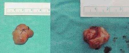 The Appearance Of The Lesions After Excision Download Scientific Diagram