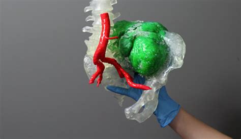 3d Printing Patient Specific Medical Models Becomes Easier Greatlight