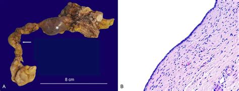 A Gross View Of The Left Seminal Vesicle Arrow And Cyst Asterisk Download Scientific