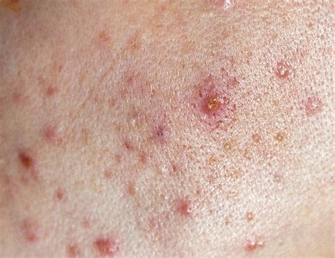 Everything To Know About Acne Prone Skin Prequel