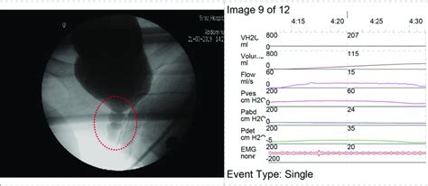 Voiding Cystourethrography With Concomitant Intravesical Pressure
