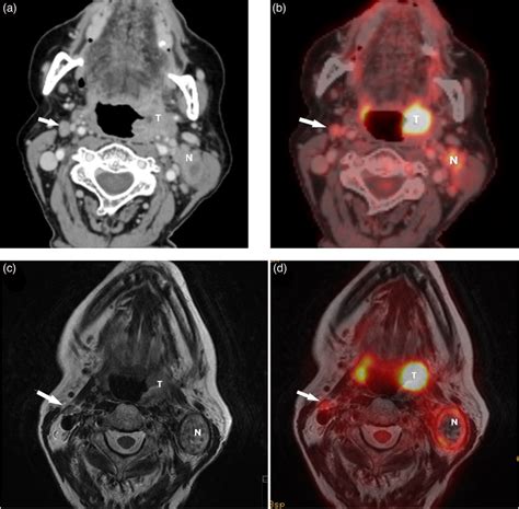 A Patient With A Scc In The Left Tonsil And Ipsilateral Metastasis The Download Scientific