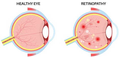 Diabetic Retinopathy Treatment In Michigan Diabetic Eye Care