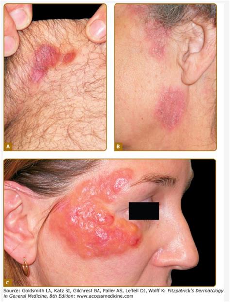 Agent Orange Skin Disease Quotes Trending