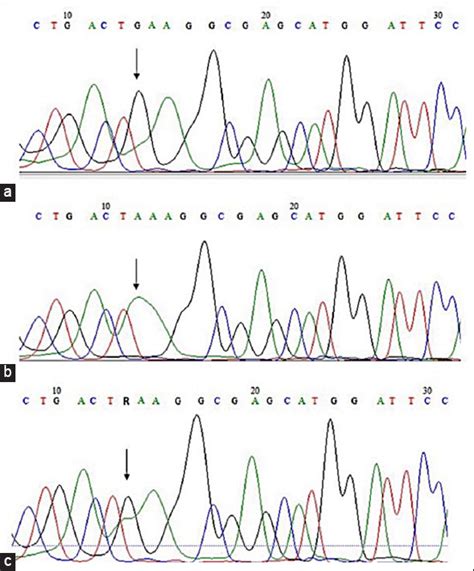 Frequency Of Superoxide Dismutase 1 C118 Ga Mutation Associated With