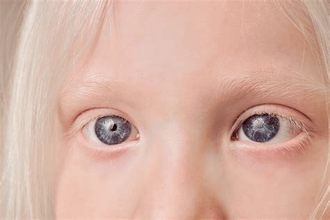 Ocular Albinism Retina Ophthalmology Notes And Synopses