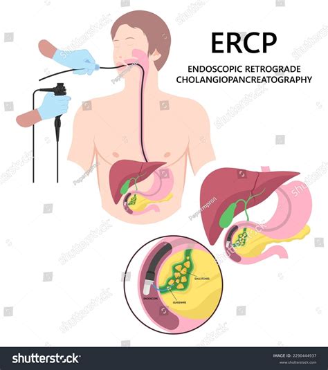 Endoscopic Retrograde Cholangiopancreatography