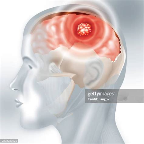 Brain Cancer High Res Vector Graphic Getty Images