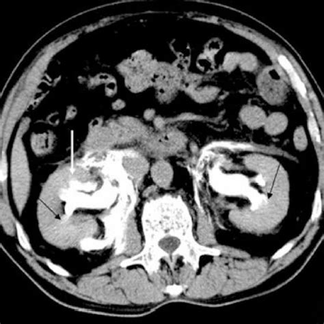 E Pyelography Demonstrates The Right Pyelosinus Backflow White Arrow
