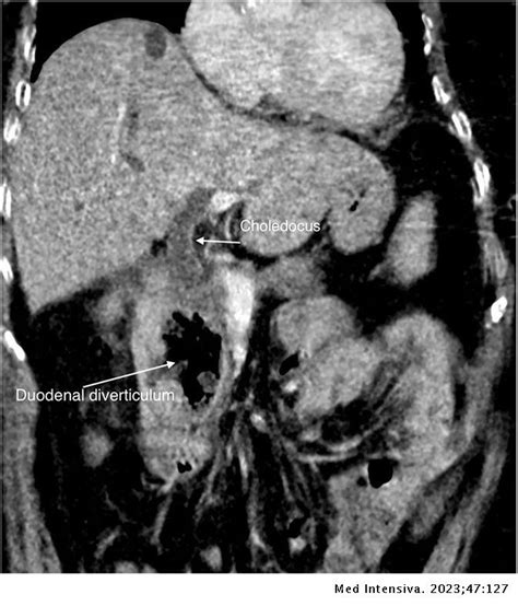 Just Another Sepsis Case Lemmels Syndrome Presenting As Acute