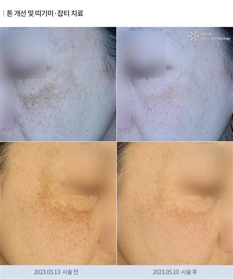 기미·잡티·미백 동탄snow의원