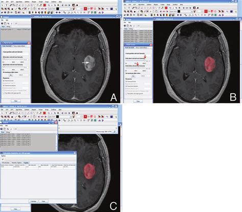 Semiautomated Method For Segmentation Of Enhancing Tumor Tissue Using