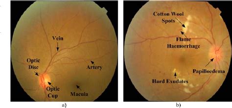 Hypertensive Retinopathy Vs Normal