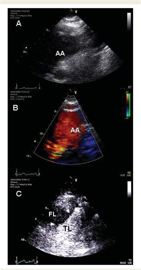 Table 1 From Impact Of Contrast Enhanced Echocardiography On The Diagnostic Algorithm Of Acute
