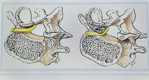 Lateral Recess Stenosis Nspc Brain And Spine Surgery