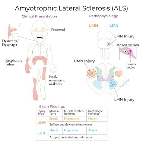 Als Syndrome Diagram The Middle Crossed Syndrome New Insights Into