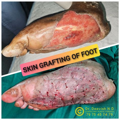 Skingrafting Plasticsurgery Drdeevishnd Healiosrnr Dr Deevish