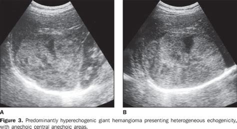 Cavernous Hemangioma Liver Ultrasound