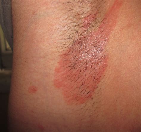 Psoriasis Dermalive