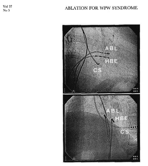 Figure 2 From Radiofrequency Ablation For Wpw Syndrome With Monitoring