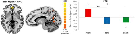 Connectivity Between Mpfc And Pcc During Resting State Axial Slice Download Scientific Diagram