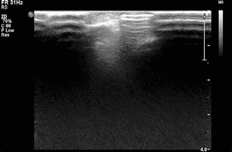 Hyperplastic Lymph Node Imaging After Injecting Ultrasound Microbubbles