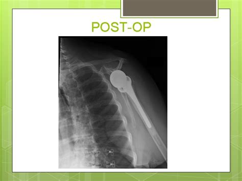 Reverse Total Shoulder Arthroplast Y Jonathan Samuelson Why