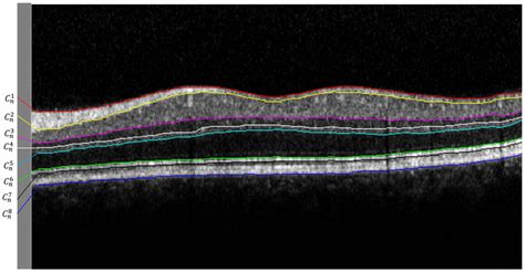 Exemplary Oct B Scan From Spectralis Sd Oct Showing Eight Intraretinal Download Scientific