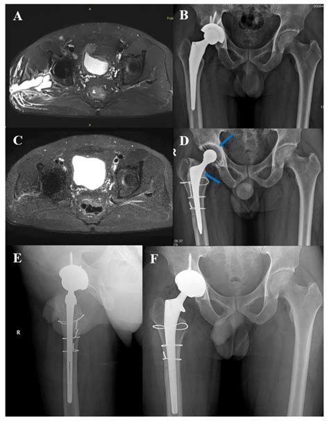 Metal Artifact Reduction Sequences Mri A Useful Reference For Preoperative Diagnosis And