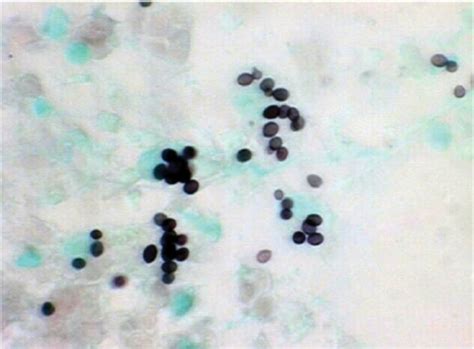 Cytology Of Lymph Node Aspirate Many Yeast Like Fungal Forms Of Round