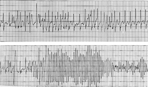 Asymptomatic Wolff Parkinson White Syndrome Cardiac Electrophysiology