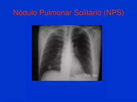 Ppt Nódulo Pulmonar Solitario Nps Powerpoint Presentation Free Download Id 6065283