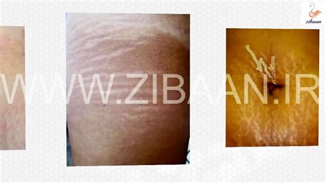 ترک های پوستی