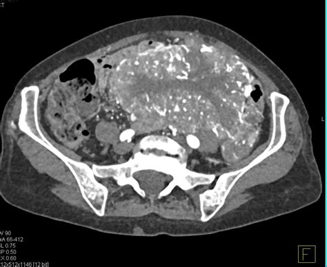 Large Gist Tumor With Neovascularity Gastrointestinal Radiology Case