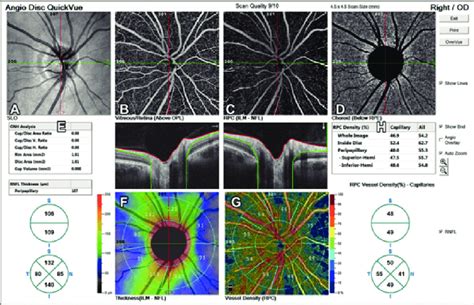Peripapillary Optical Coherence Tomography Angiography Report Of An Eye