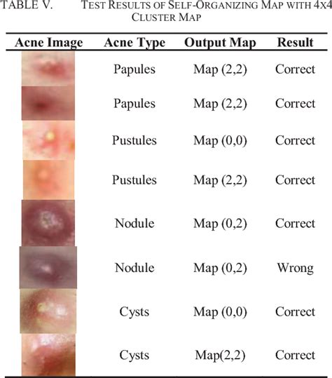 Table V From Acne Segmentation And Classification Using Region Growing And Self Organizing Map